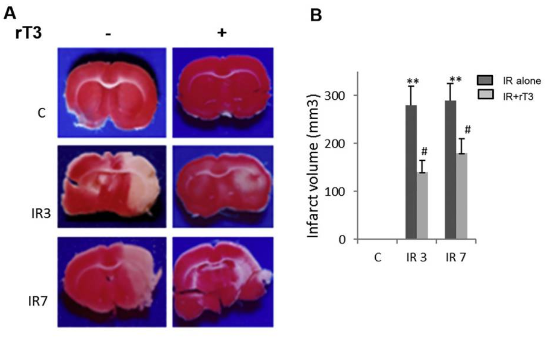 Reverse T3 Inhibits T4 to T3 Conversion – IBS, Fibromyalgia, CFS/ME ...